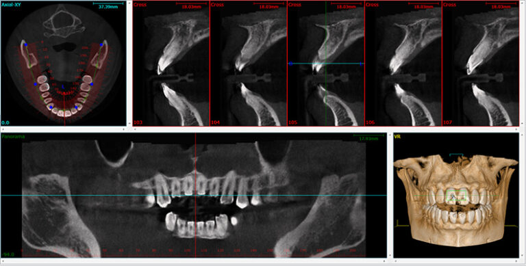 Ventajas de utilizar CBCT en endodoncia - Clínica dental IOM Ventajas de utilizar CBCT en endodoncia - Clínica dental IOM