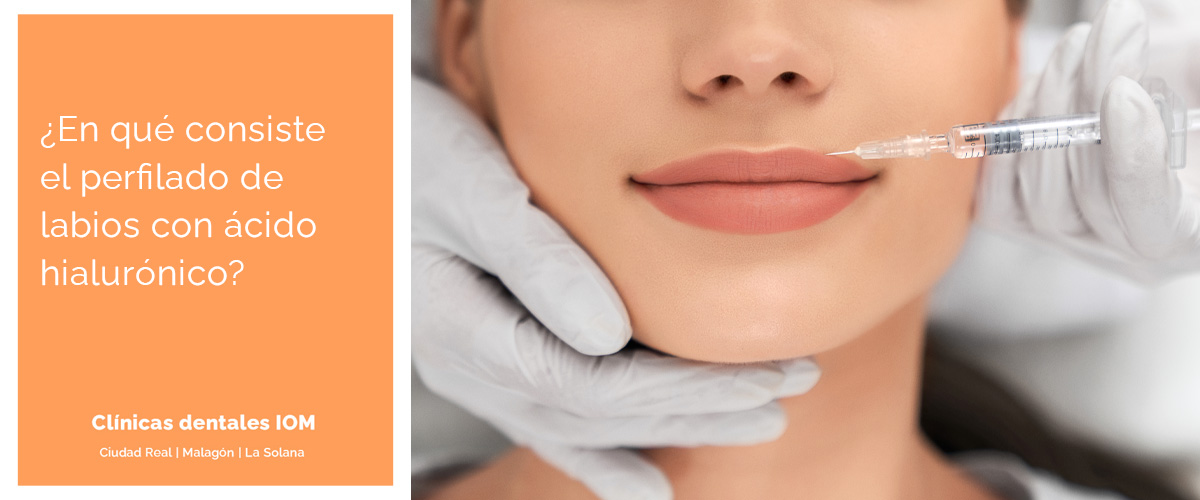 Perfilado de labios con ácido hialurónico?