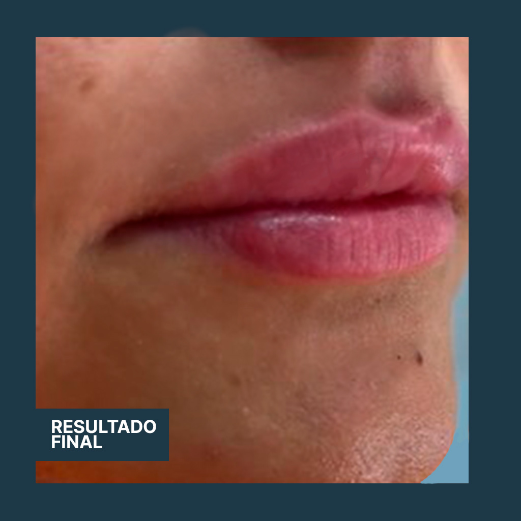 Ácido Hialurónico en Ciudad Real | Instituto Odontológico Manchego