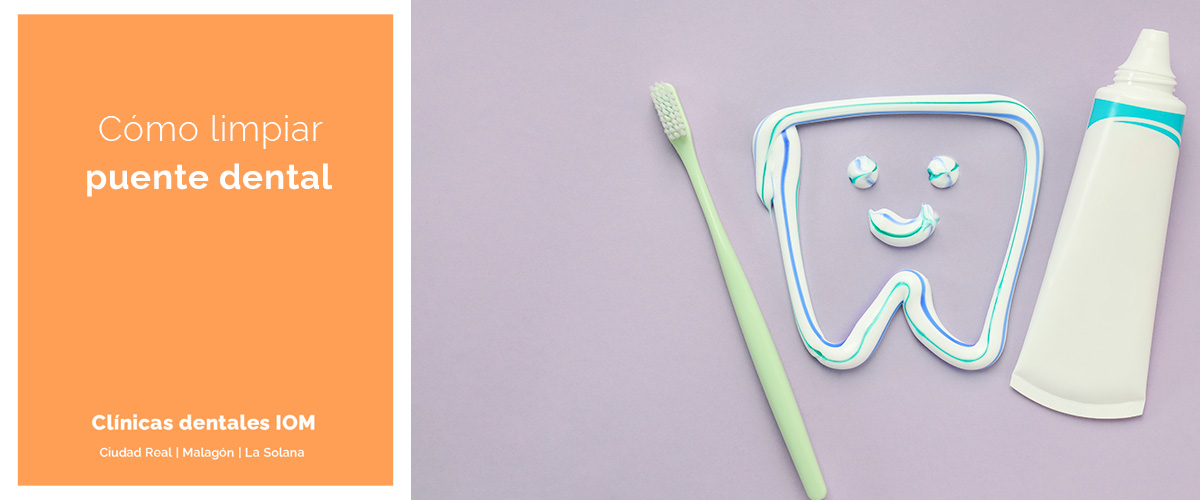 Cómo limpiar puente dental - Clínica dental IOM