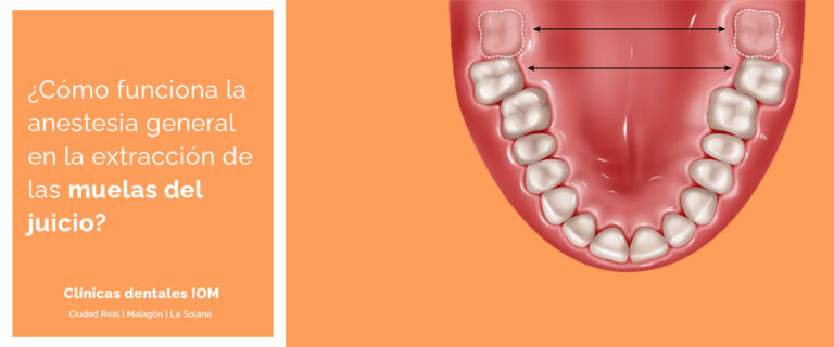 ¿Cómo funciona la anestesia general en la extracción de las muelas del ...