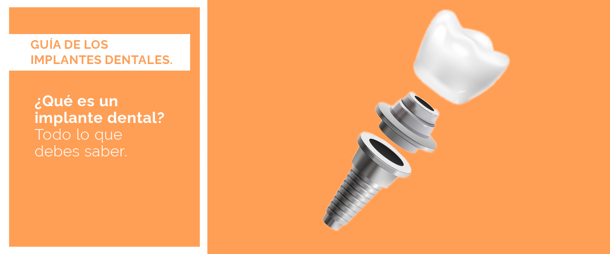 ¿Qué es un implante dental? Todo lo que debes saber