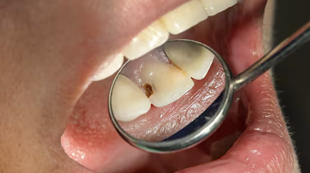 Caries interproximal: Qué es, causas y cómo tratarla de forma efectiva.