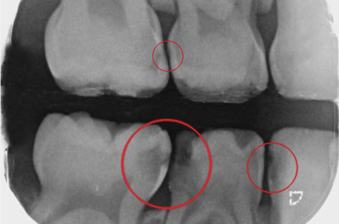 Caries interproximal: Qué es, causas y cómo tratarla de forma efectiva.